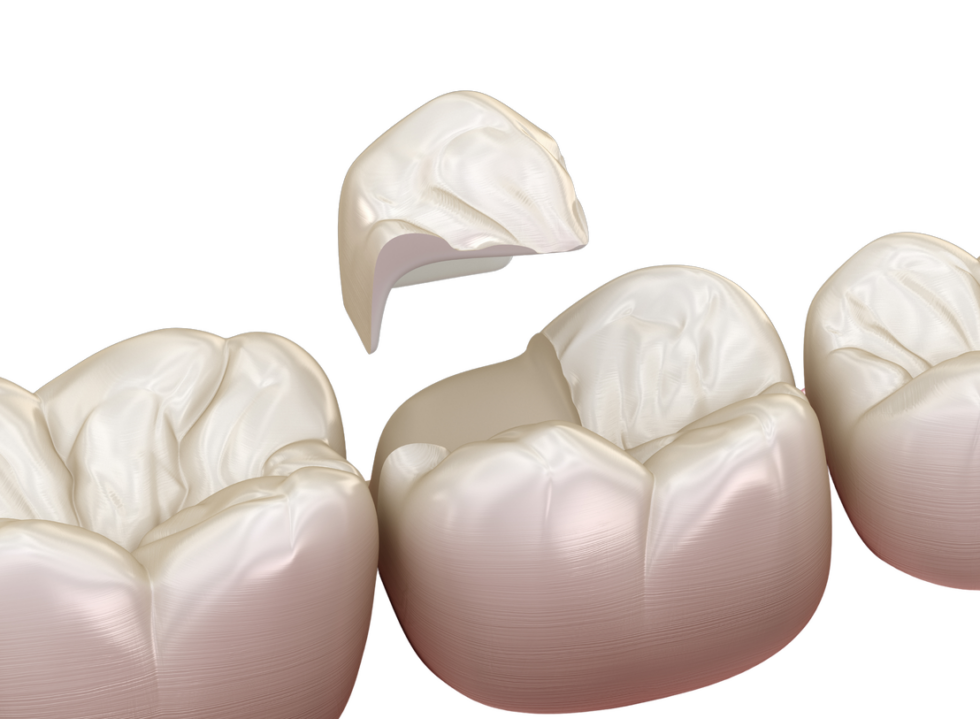 Inlays: Precise Tooth Restoration | Best Dental Services